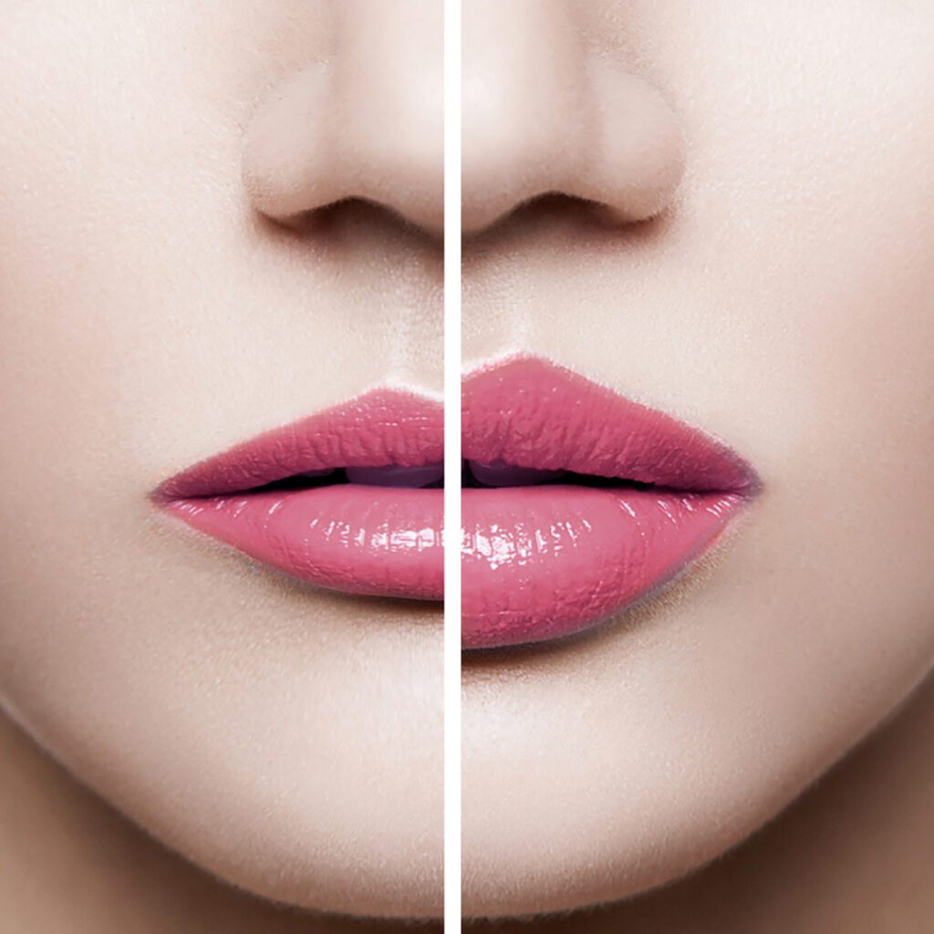 Tot ce trebuie să știi despre injectarea cu acid hialuronic | Dr. Radu ...